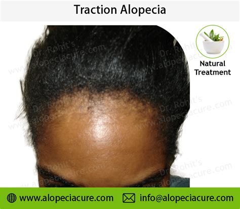 Traction Alopecia Treatment