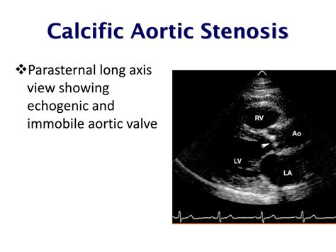 Ppt Echocardiographic Assessment Of Aortic Valve Stenosis Powerpoint