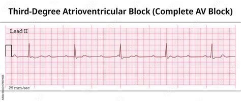 Ecg Third Degree Atrioventricular Block Complete Av Block 8 Second Ecg Paper