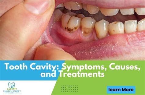 Tooth Cavity Symptoms Causes And Treatments Church Street Dental