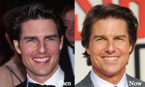 Tom Cruise Plastic Surgery Before And After Photos Latest Plastic