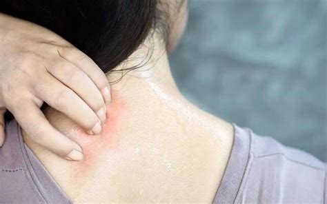 نکات طلایی برای پیشگیری و درمان عرقسوز شدن