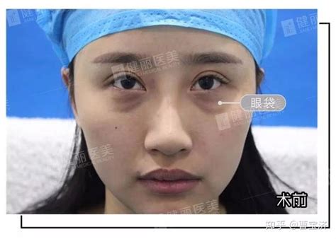 为什么你的眼袋越来越大？全部真相都在这里了！ 知乎
