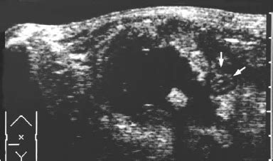 Appendiceal Abscess Large Abscess Cavity Contains A Fecalith Note The Download Scientific