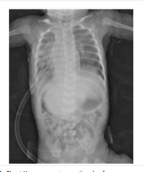 Figure 1 From Right Sided Congenital Diaphragmatic Hernia Semantic