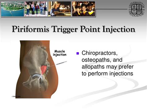 Myofascial Injections Trigger Point Piriformis