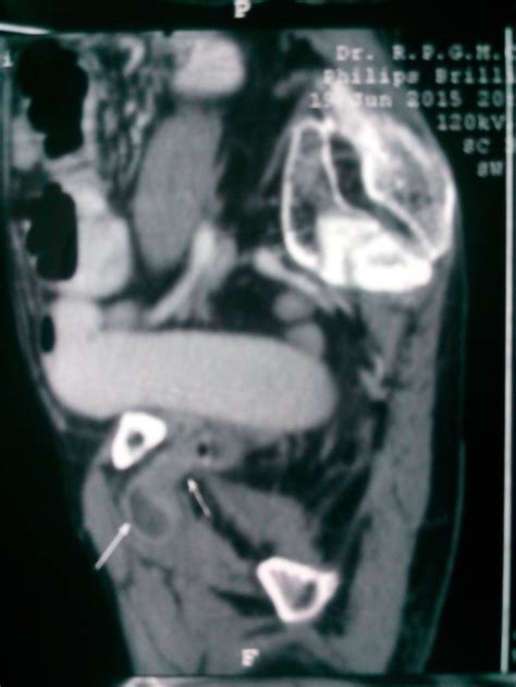 Ct Image Of Obturator Hernia Download Scientific Diagram