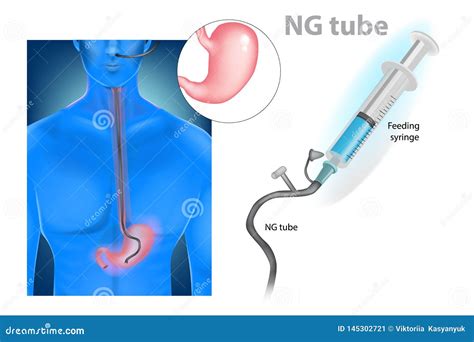 Nasogastric Enteral Feeding Tube Passed To Stomach Infographics Vector