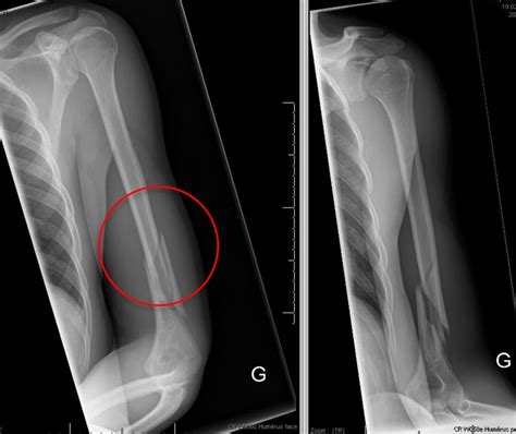 Dr Nicolas Rueff Chirurgie Orthopédique Et Traumatologie Hôpital De