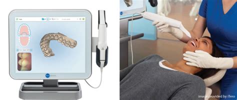 Digital Occlusion Analysis Vs Intraoral Scanners Tekscan
