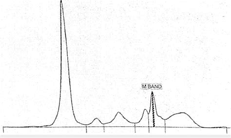 Serum Protein Electrophoresis Peripheral Neuropathy At Stanley Shirlene