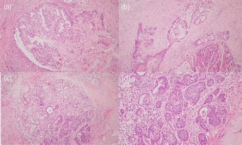 Necrotizing Sialometaplasia Histology
