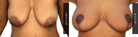Extra Large Breast Augmentation Before And After