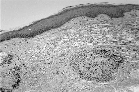 Histopathological Examination Tuberculous Granulations Is Visible In