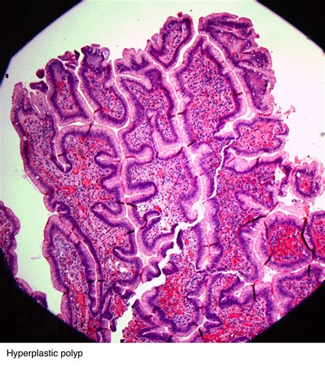 Hyperplastic Polyp Gi Histology Week 3 Studyblue Hyperplastic Polyp Gi Histology Week 3 Studyblue