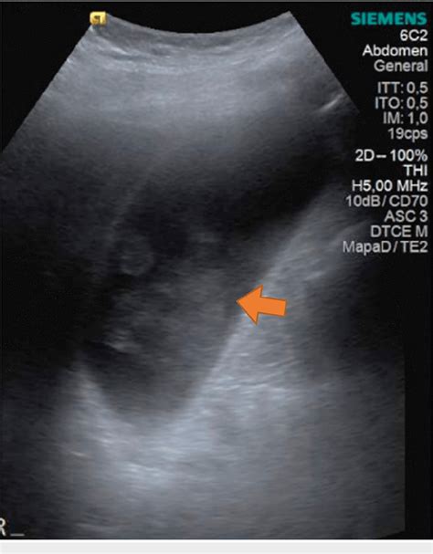 [pdf] Synchronous Acute Appendicitis And Acute Cholecystitis Semantic Scholar