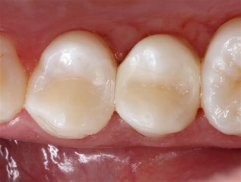 Clinical Guide Class Ii Restoration Of First Premolar With