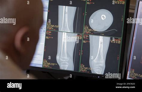 Bone Cancer Scan Stock Videos And Footage Hd And 4k Video Clips Alamy