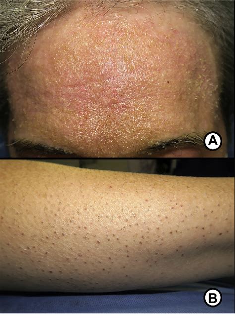 Co Occurring Features Of Scurvy And Phrynoderma In The Same Patient
