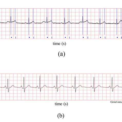 A Normal Ecg Signal B Apnea Ecg Signal Download Scientific Diagram