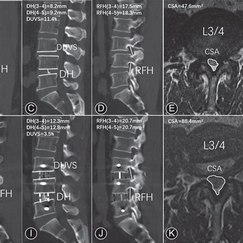 One Year Postposterior Lumbar Interbody Fusion Plif Using Porous