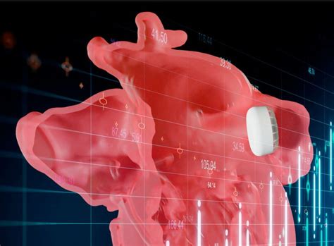 Materialise Adds New Medical Procedure To Mimics Enlight 3d Planning