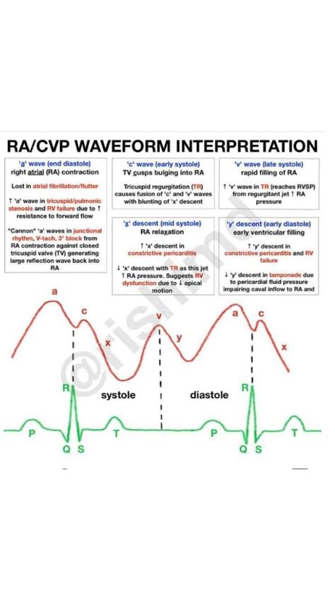 Racvp Waveform Interpretation Creditrishimd Nursing School Humor