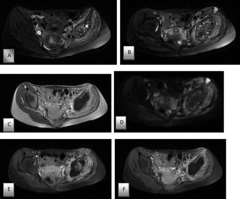 MRI Images A B Axial T2 Weighted Images C Axial T1 Weighted