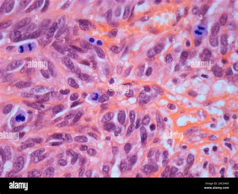 Mitotic Index Light Micrograph Of A Section Through A Malignant