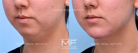 Jawline And Masseter In The San Francisco Bay Area Mabrie Facial Institute