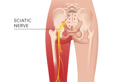 Sciatica Causes Warning Signs And Treatment Options