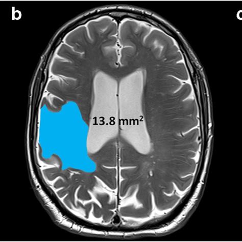 Exemplary Segmentation Of The Mprage Sequence In Patients With Small