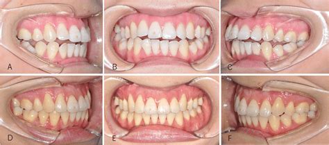 Occlusion Of The Patient In Fig 8 A C Preoperative Occlusion