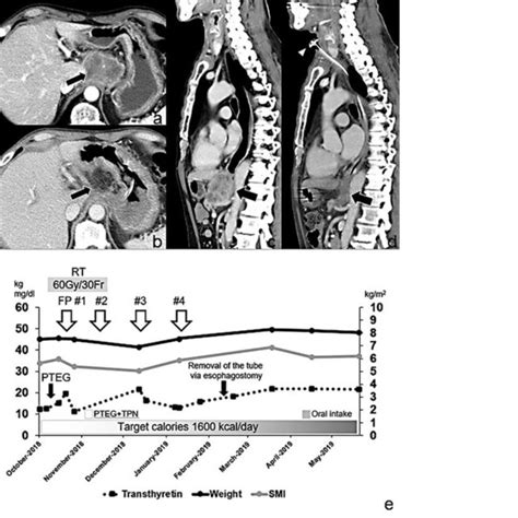 A Axial Contrast Enhanced Computed Tomography Ct Image Before