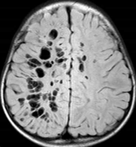 Soap Bubble Lesions Cryptococcus Neoformans In Brain