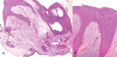 Polypoid Corditis Reinke Edema Of The Larynx Pmc