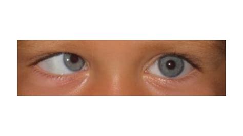 Infantile Congenital Esotropia