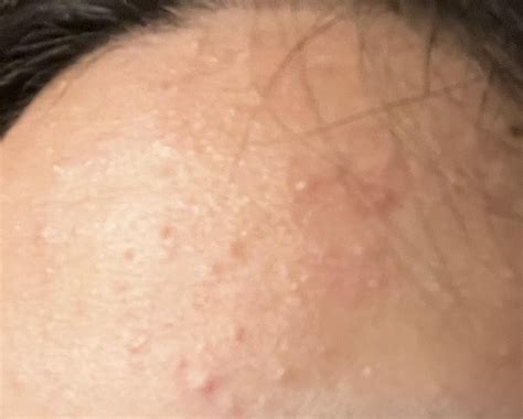 Weird Acne Racne