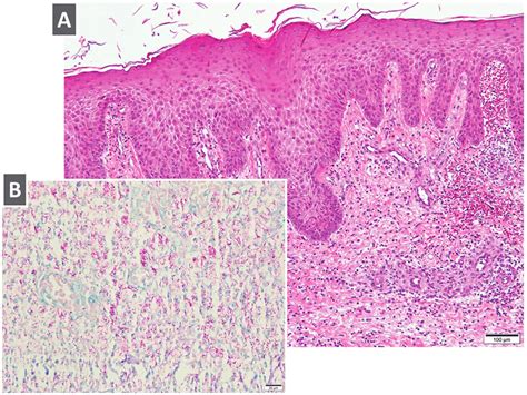 Histopathological Analyses Of Skin Biopsy Samples A Hematoxylin And