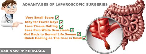 Appendix Symptoms And Treatment With Laparoscopic Surgery By Habilite