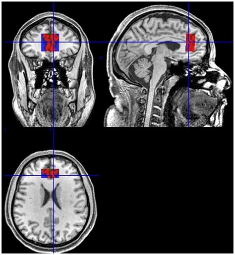Obsessive Compulsive Personality Disorder Brain