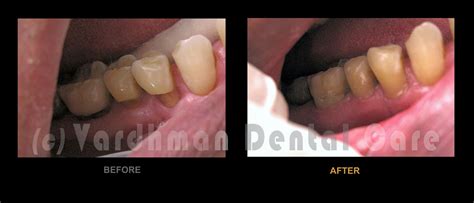 Abrasion Abfraction Correction Mr C C Jul 10 Vdc Img 9694 9694 Flickr Photo Sharing