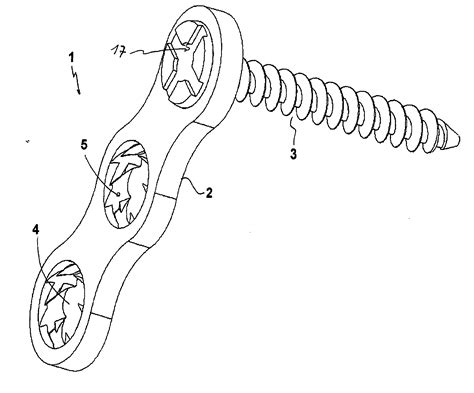 Osteosynthesis Device Eureka Patsnap