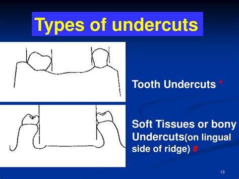 Undercuts In Dental At Tina Ducote Blog