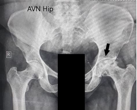 Case Study Left Hip Total Replacement In 50 Year Old Female