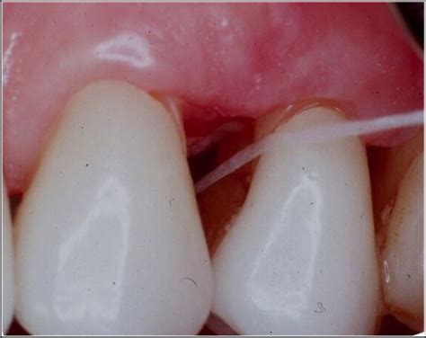 Periodontal Management Time To Go Beyond Reduced Probing Depths May