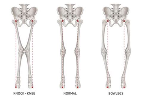 Knee Alignment Surgery Delray Beach Fl Leg Correction Boca Raton