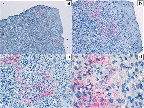 Usefulness Of New Automated Treponemal Tests In The Diagnosis Of Early