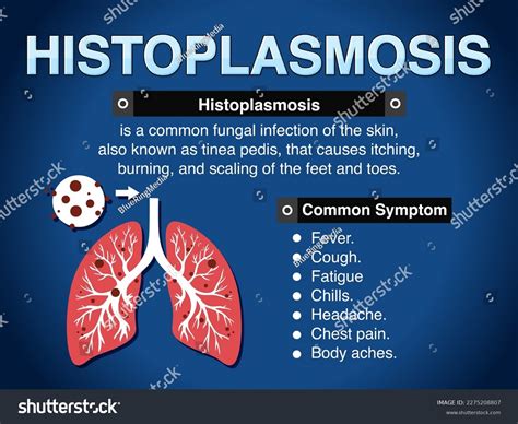 Informative Poster Histoplasmosis Illustration Stock Vector Royalty