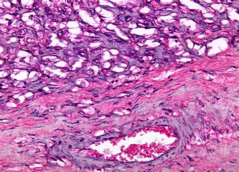 Leiomyosarcoma At 20x Magnification Nikons Microscopyu